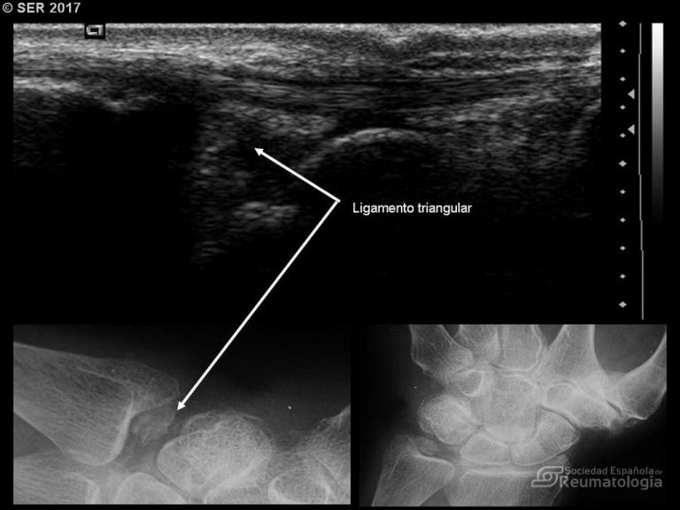 Condrocalcinosis ligamento triangular del carpo - Sociedad Asturiana de ...