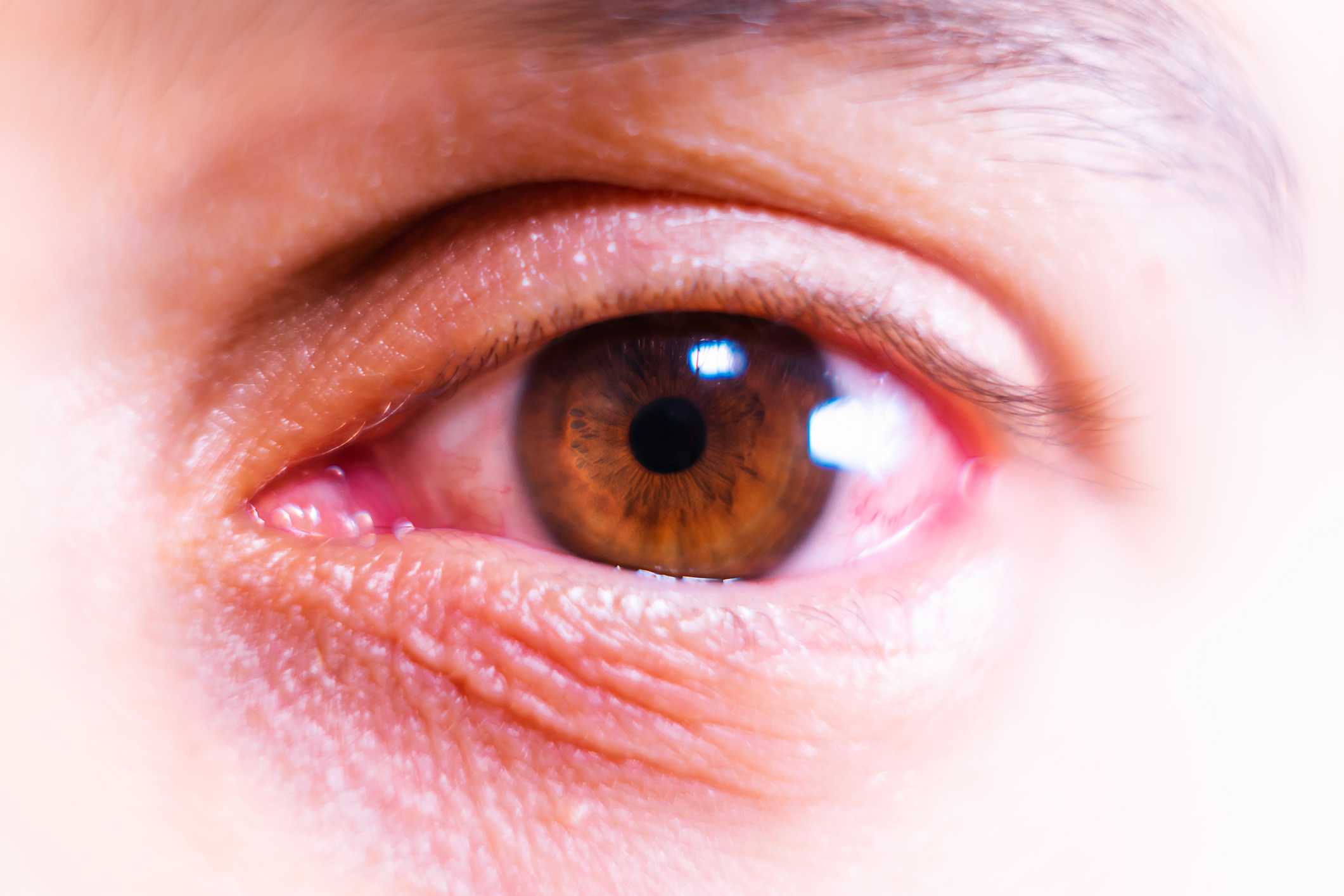 Uveitis - Sociedad Asturiana de Reumatología